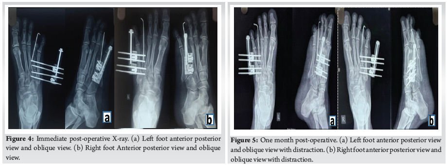 A Modified Deformity Correction Method for Congenital Brachymetatarsia ...