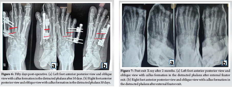 A Modified Deformity Correction Method for Congenital Brachymetatarsia ...