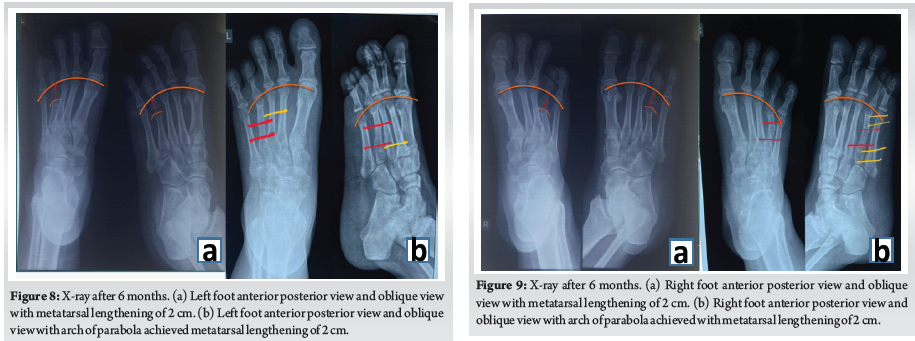 A Modified Deformity Correction Method for Congenital Brachymetatarsia ...