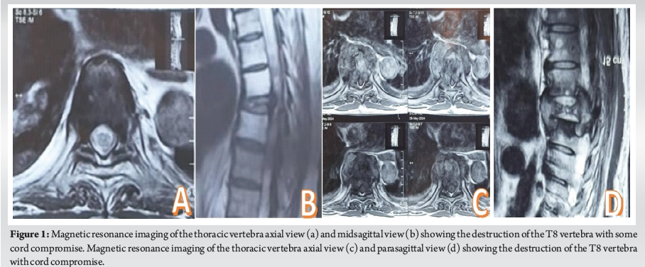 Total En Bloc Spondylectomy for Thoracic (T8) Spinal Metastasis of ...