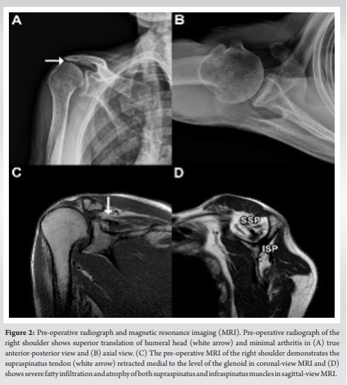 Combined Lower Trapezius and Middle Trapezius Tendon Transfer for ...
