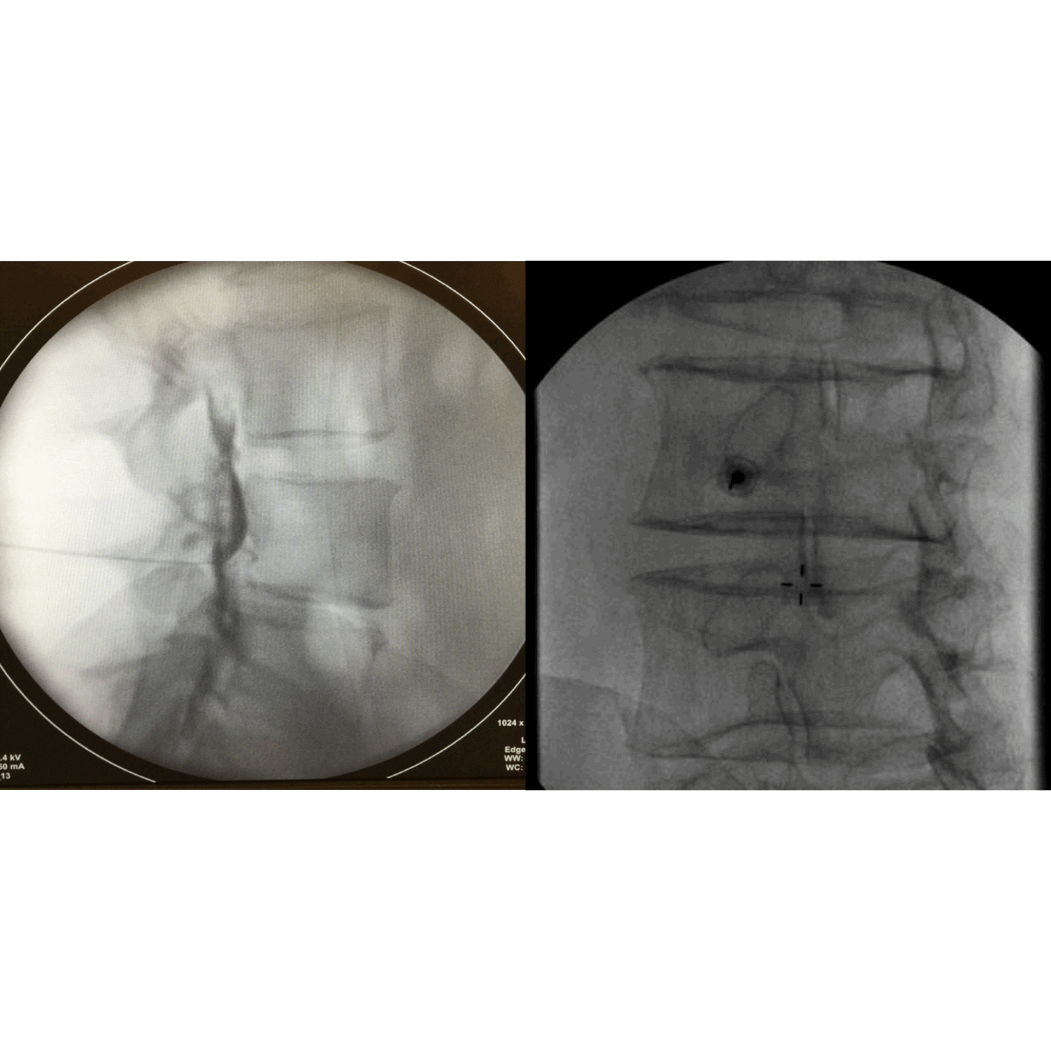 Effectiveness of Epidural Methylprednisolone Injection in Management of ...