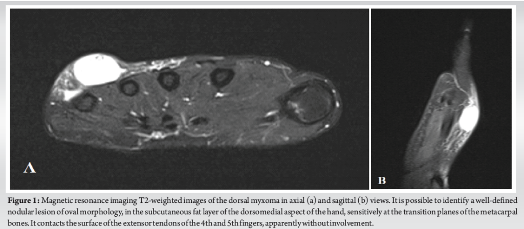 Myxoma of the Dorsal Aspect of the Hand – A Case Report of a Rare ...