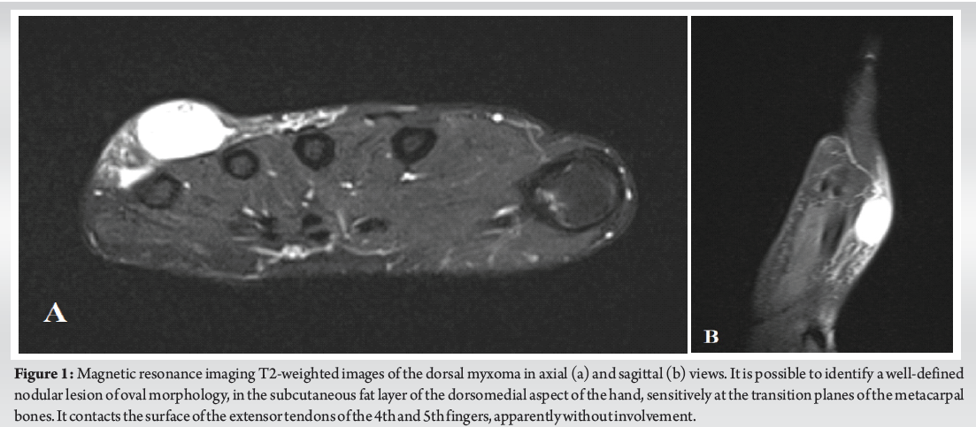 Myxoma of the Dorsal Aspect of the Hand – A Case Report of a Rare ...