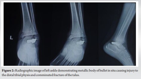 Gunshot Injury to Distal Tibial Physis and Talus: A Case Report ...