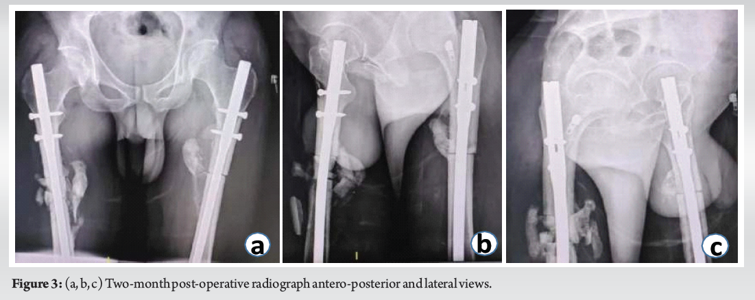 Neglected Bilateral Shaft Femur Fracture – A Case Report | Journal of ...