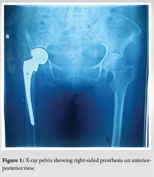 Two Stage Revision Total Hip Arthroplasty for Enterobacter Induced Periprosthetic Joint ...