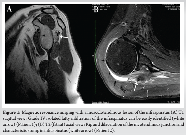 Irreparable Isolated Infraspinatus Musculotendinous Lesion Treated With ...