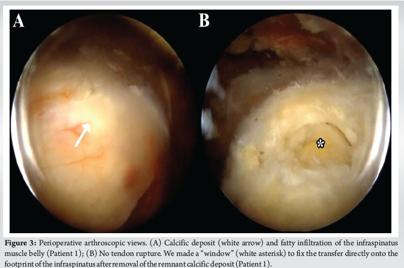 Irreparable Isolated Infraspinatus Musculotendinous Lesion Treated With ...