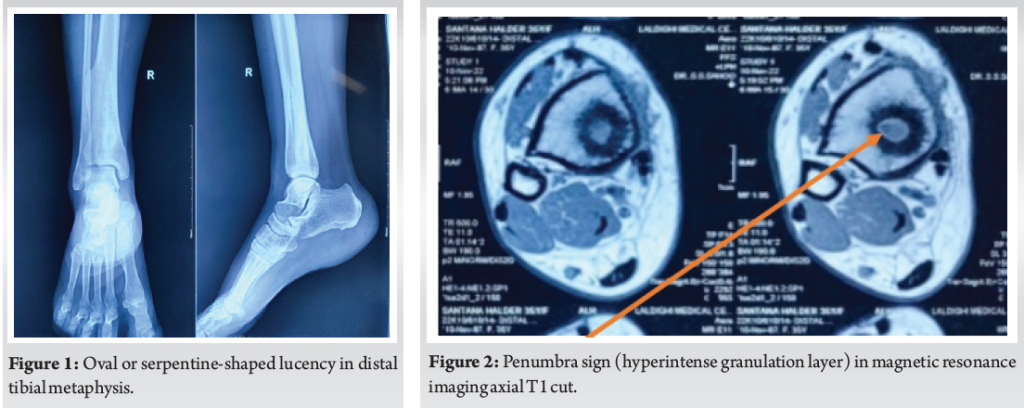 Unusual Sites of Brodie’s Abscess and the use of Calcium Sulfate Beads ...