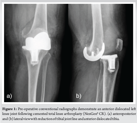 Traumatic Knee Joint Dislocation in a Total Knee Arthroplasty with ...