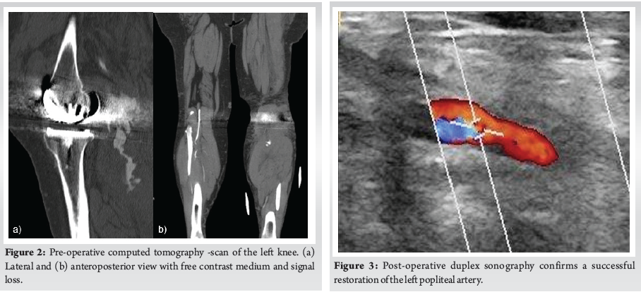 Traumatic Knee Joint Dislocation in a Total Knee Arthroplasty with ...