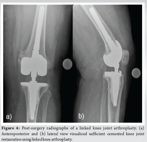 Traumatic Knee Joint Dislocation in a Total Knee Arthroplasty with ...