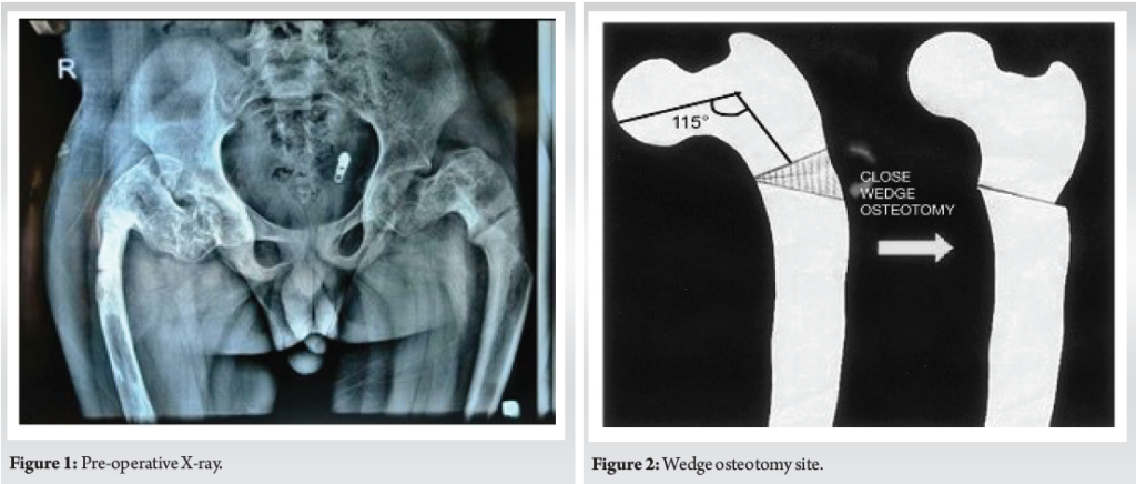 A Case Report of Bilateral Shepherd Crook Deformity of Proximal Femur ...