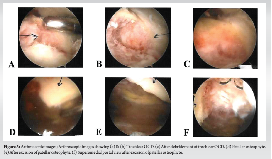 Locked Knee and Inferior Patellar Dislocation in an Elderly Patient: A ...