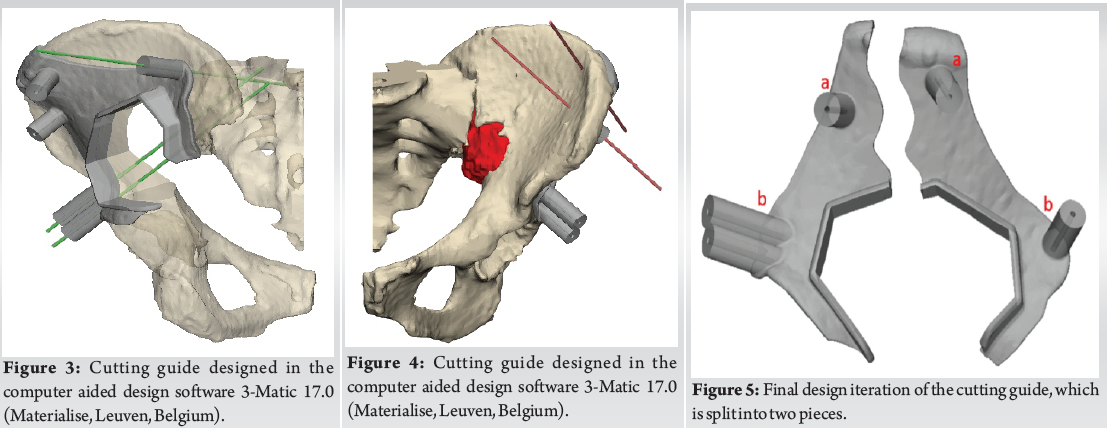 3D-Printed Cutting Guide in Oncological Pelvic Surgery: A Case Report ...