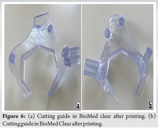 3D-Printed Cutting Guide in Oncological Pelvic Surgery: A Case Report ...