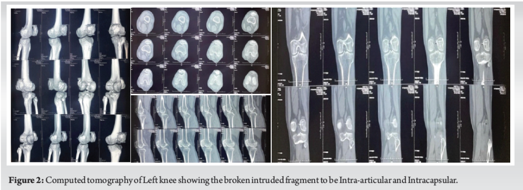 “Intra-Articular Intrusion of Broken Patella Cerclage Wire and the ...