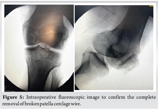 “Intra-Articular Intrusion of Broken Patella Cerclage Wire and the ...
