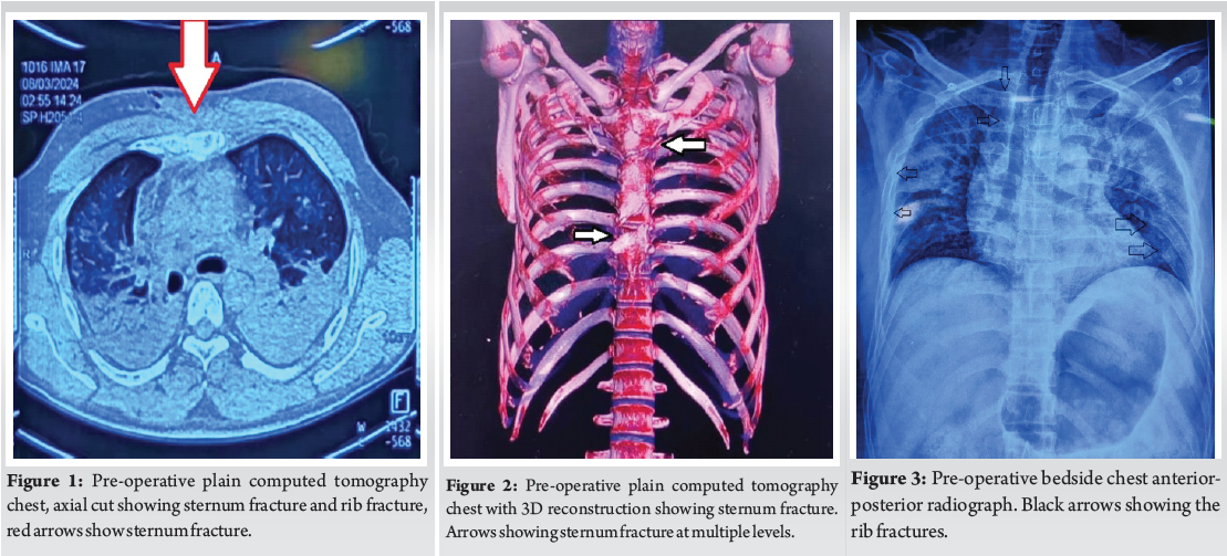 A Devastating Chest Injury: A Case Report | Journal of Orthopaedic Case ...