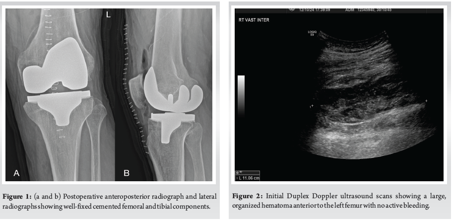 An Unusual Presentation of Delayed Hemarthrosis Following Total Knee ...