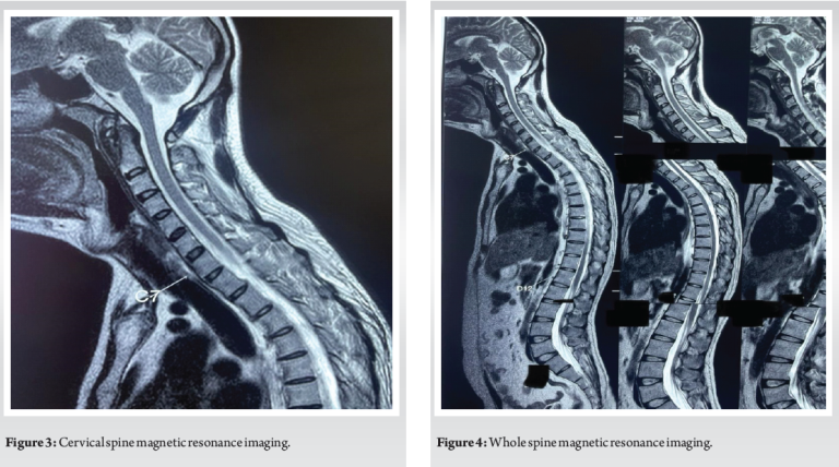 An Unusual Case of Early-onset Ankylosing Spondylitis with Predominant ...