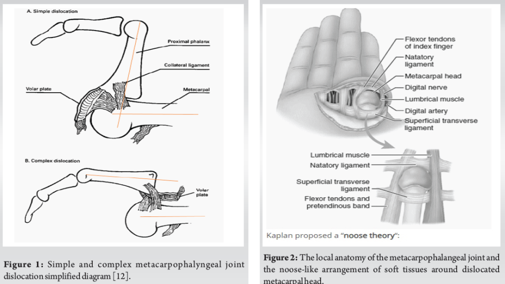 Metacarpophalangeal Joint Dislocations Two Cases, Two Stories | Journal ...