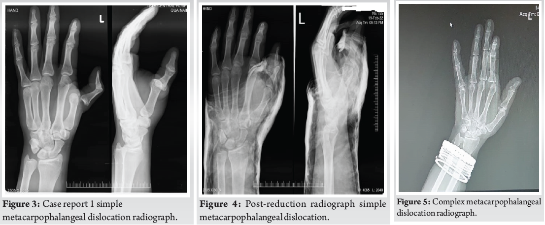 Metacarpophalangeal Joint Dislocations Two Cases, Two Stories | Journal ...