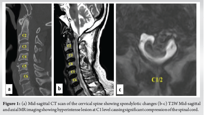 MIS transoral technique for C1-C2 cord compression – Intricacies using ...