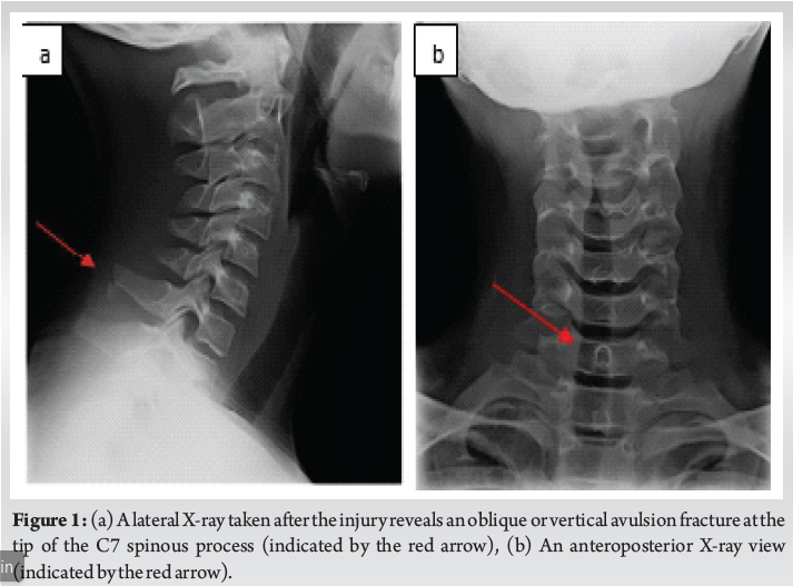 Clay-shoveler’s Fracture in a 13-year-old Child – Case Report and ...