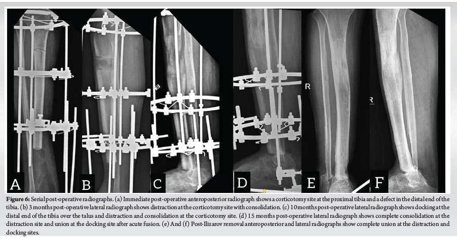 A Rare Case Report of Giant Cell Tumor in the Distal Tibia: Management ...