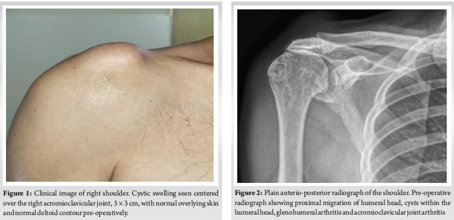 A Silent Shoulder of Plentiful Pathology: An Uncommon Presentation of ...