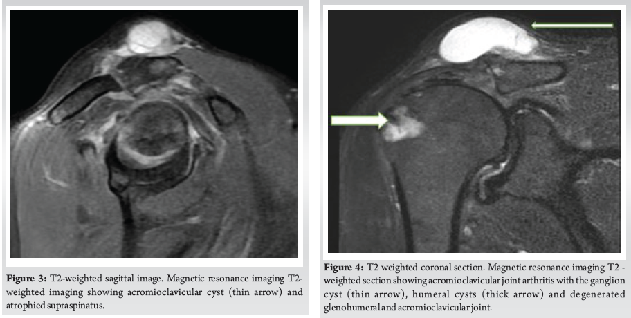 A Silent Shoulder of Plentiful Pathology: An Uncommon Presentation of ...