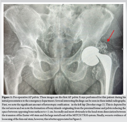 Metallosis, Trunnionosis, and Head-stem Dissociation of the Exeter v40 ...