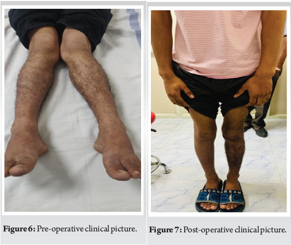 Single Level Closed Wedge Osteotomy for Bilateral Genu Valgus with ...