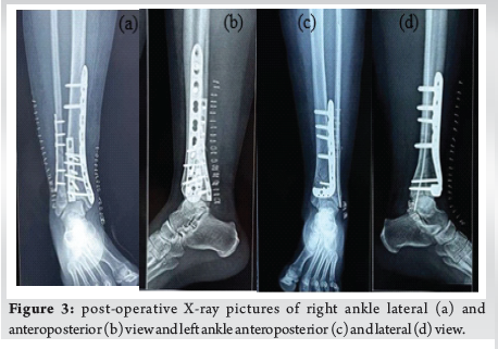 Trimalleolar Fracture of the Bilateral Ankles: A Rare Case Report ...