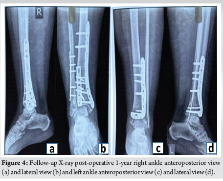 Trimalleolar Fracture of the Bilateral Ankles: A Rare Case Report ...
