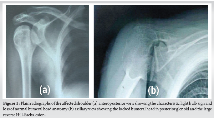 Surgical Management of Chronic Locked Posterior Dislocation of Shoulder ...
