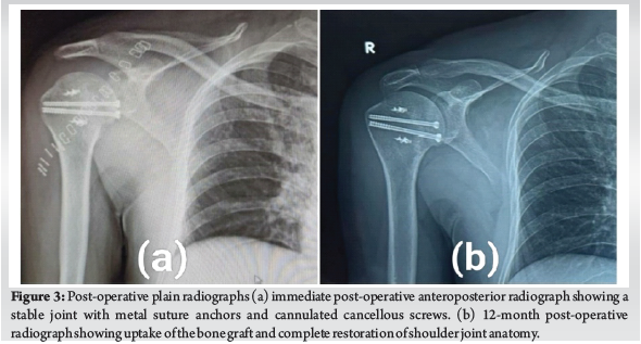 Surgical Management of Chronic Locked Posterior Dislocation of Shoulder ...