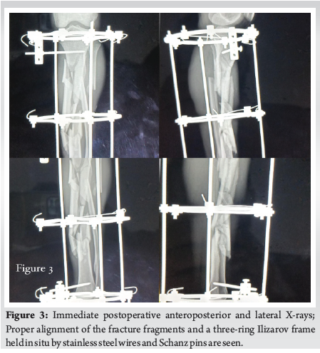 Circular Fixation, Endless Possibilities: Rebuilding a Shattered Tibia ...