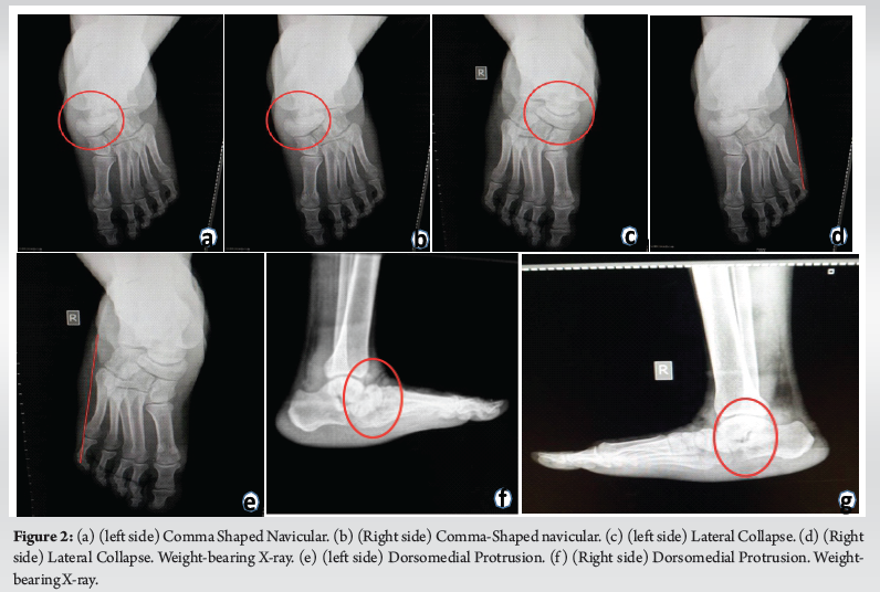 Mueller-Weiss Syndrome, a Rare Cause of Flatfoot: Case Report | Journal ...