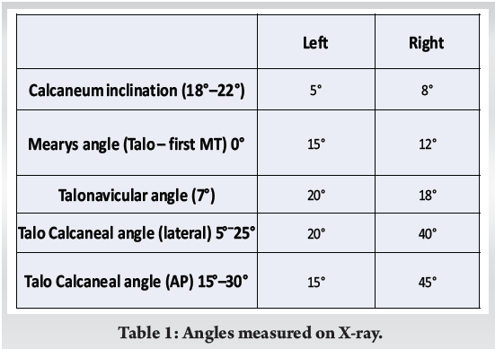 Mueller-Weiss Syndrome, a Rare Cause of Flatfoot: Case Report | Journal ...
