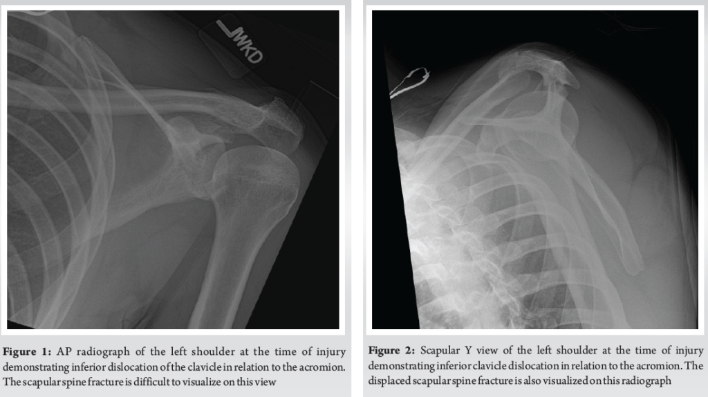 Subacromial Distal Clavicle Dislocation with Associated Scapular Spine ...