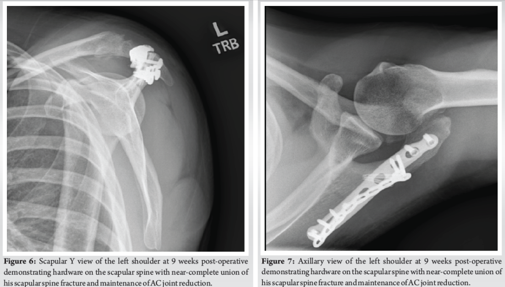 Subacromial Distal Clavicle Dislocation with Associated Scapular Spine ...