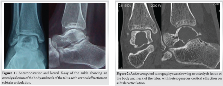 Aneurysmal Bone Cyst of Talus: A Case Report | Journal of Orthopaedic ...
