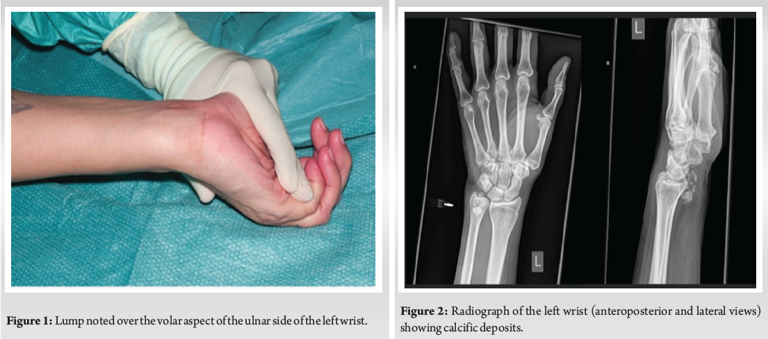 Ulnar Nerve Compression At The Wrist Secondary To Heterotopic 3030