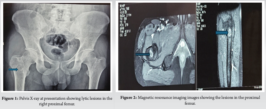 Disseminated Skeletal Cryptococcosis: A Case Report | Journal of ...
