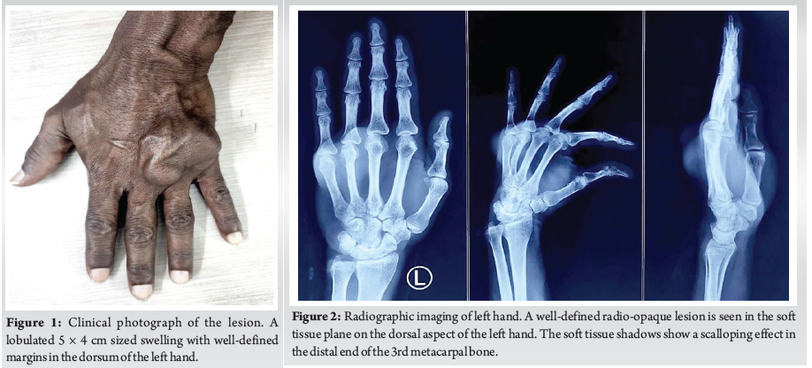 Extra-Axial Soft Tissue Chordoma of Hand: A Rare Case Report | Journal ...
