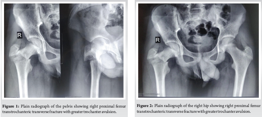 Transtrochanteric Transverse Fracture of Proximal Femur in Pediatric ...