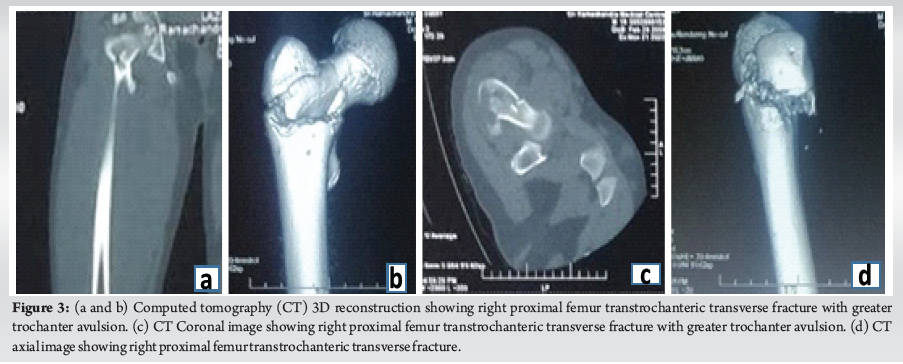 Transtrochanteric Transverse Fracture of Proximal Femur in Pediatric ...